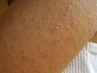 Voici à quoi sont dus ces petits boutons sur vos bras – Haus und Garten